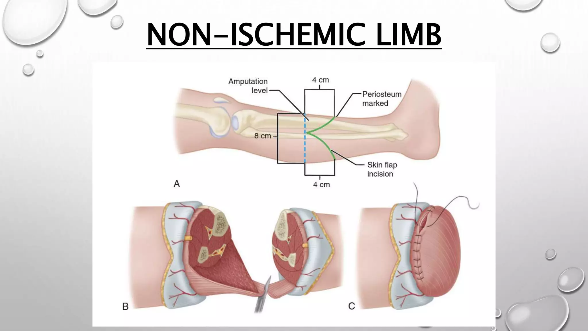 Lower limb amputation | PPTX