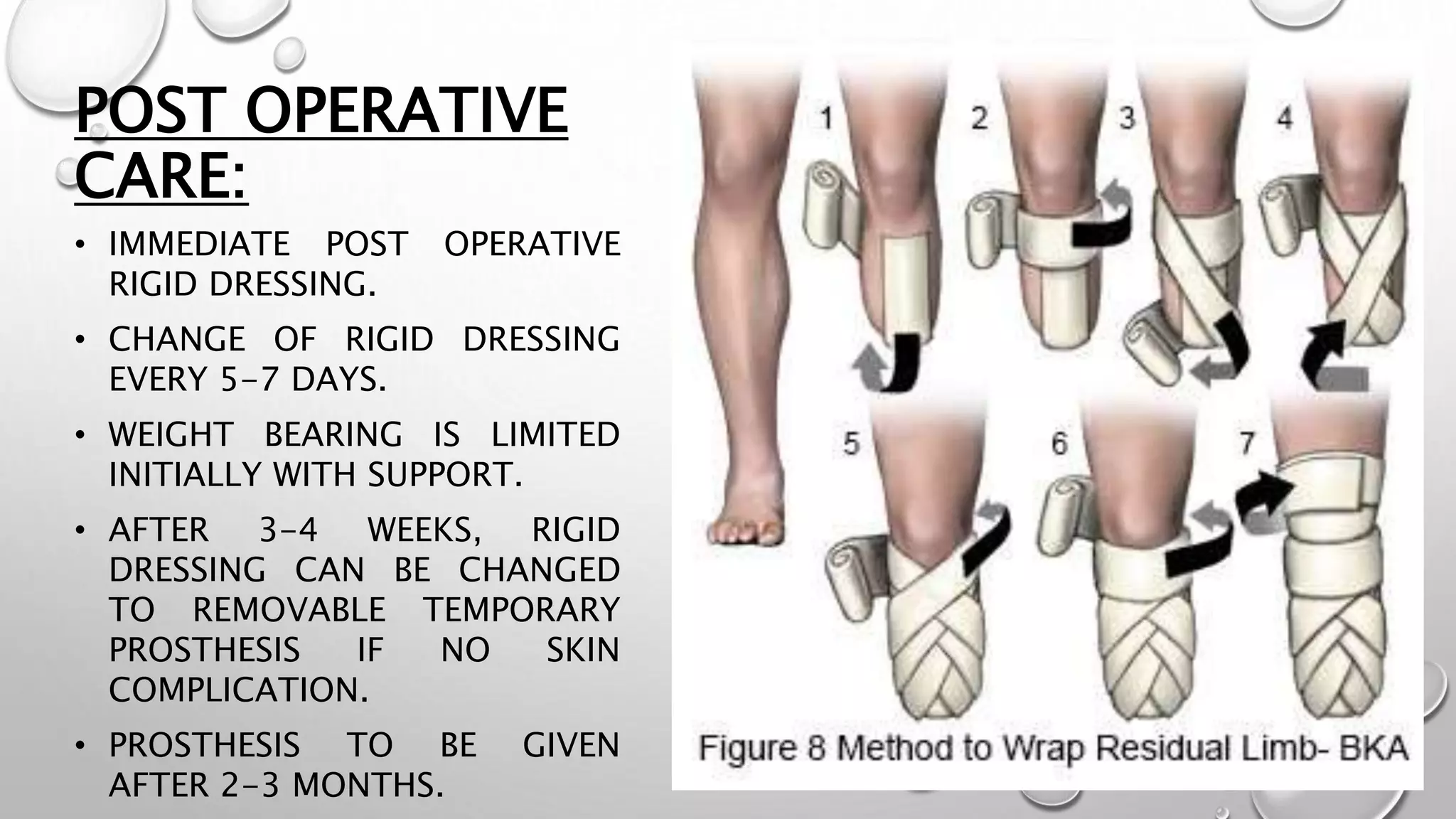 Lower limb amputation | PPTX