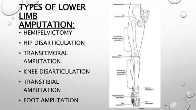 Lower limb amputation | PPTX