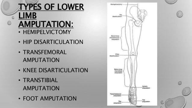 Lower limb amputation
