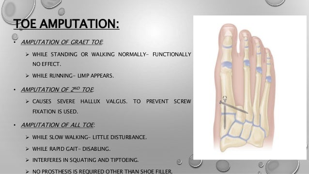 Lower limb amputation