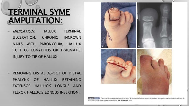 Lower limb amputation