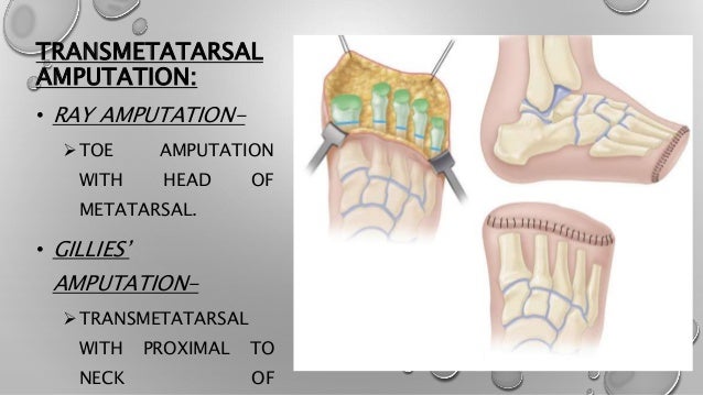 Lower limb amputation