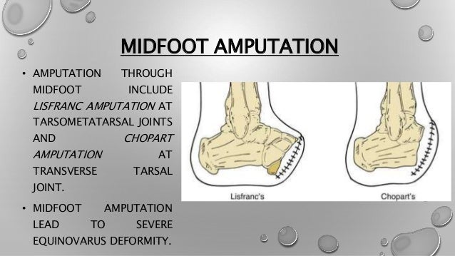 Lower limb amputation