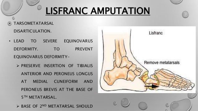 Lower limb amputation