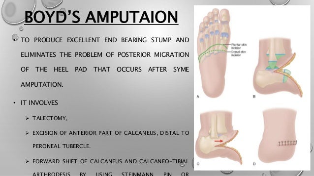 Lower limb amputation