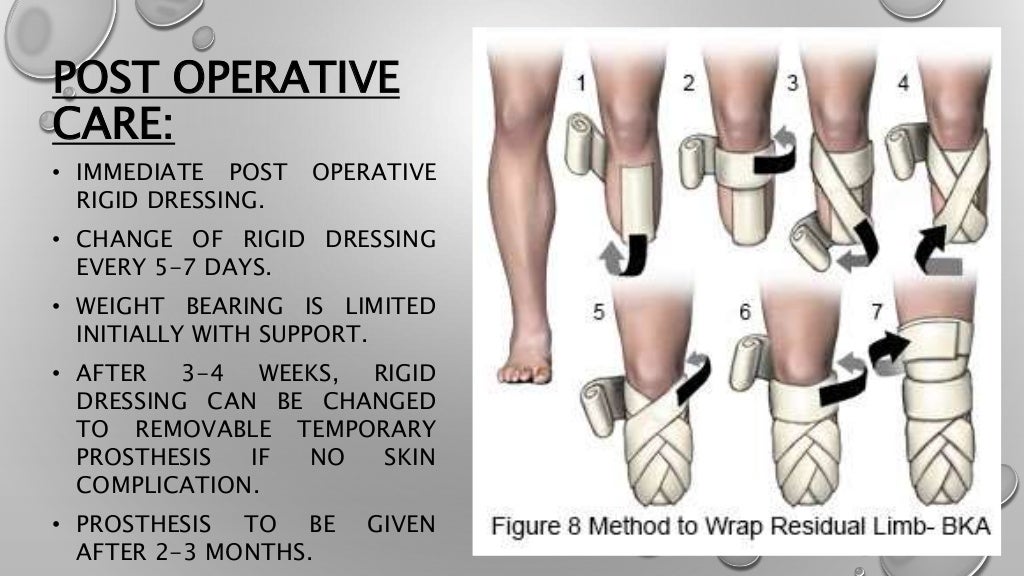 Lower limb amputation