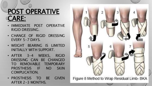 Lower limb amputation