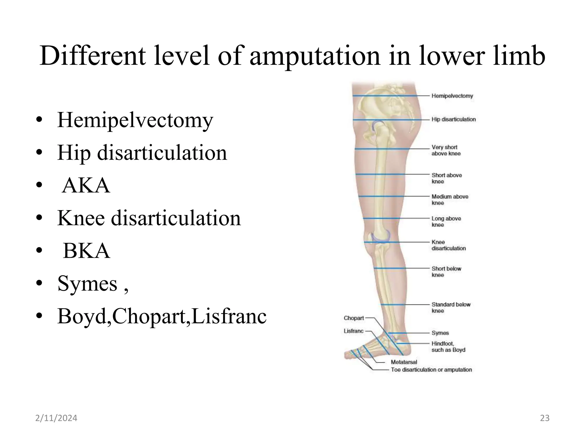 Lower limb Amputation.pptx