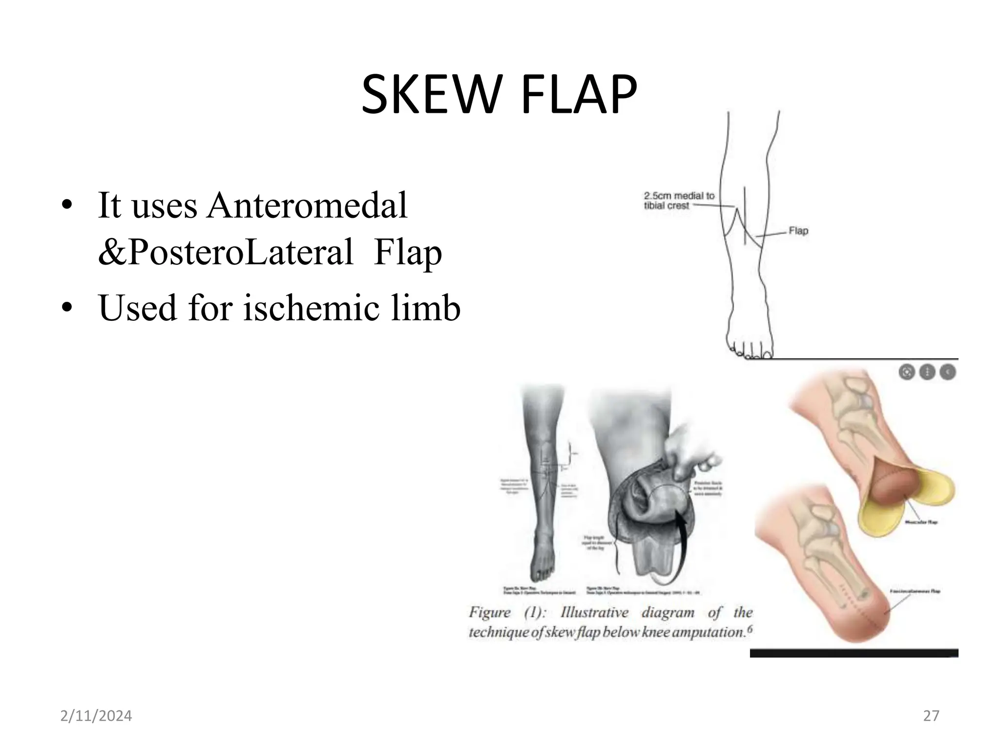 Lower limb Amputation.pptx