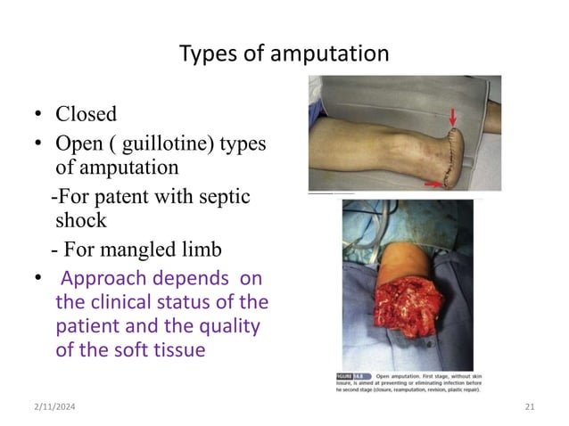 Lower limb Amputation.pptx | Injuries | Diseases and Conditions
