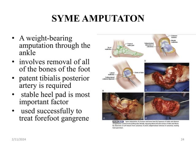 Lower limb Amputation.pptx | Injuries | Diseases and Conditions