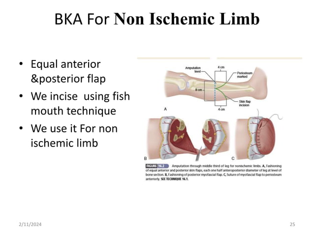 Lower Limb Amputation Pptx Injuries Diseases And Conditions