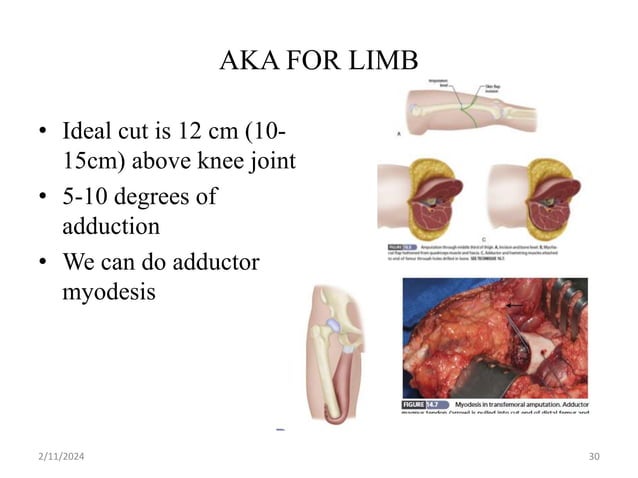 Lower limb Amputation.pptx | Injuries | Diseases and Conditions