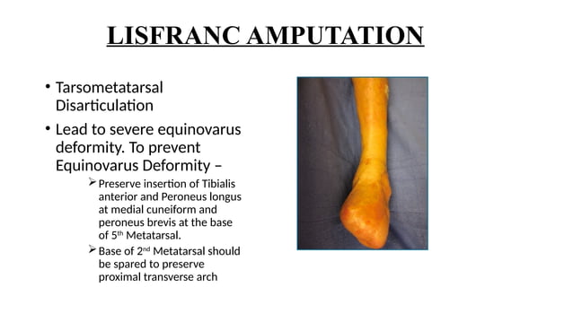 LOWER LIMB AMPUTATION SO much for [1].pptx | Free Download