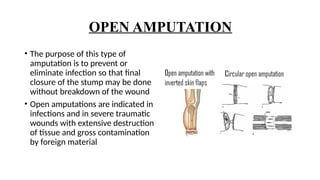 LOWER LIMB AMPUTATION SO much for [1].pptx