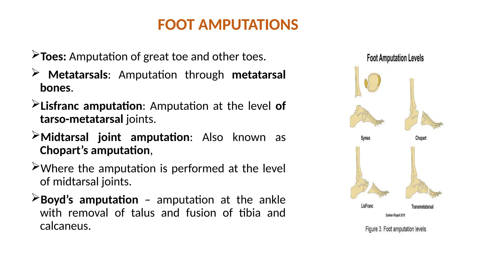 LOWER LIMB AMPUTATION Amputation is the surgical removal of a limb or ...