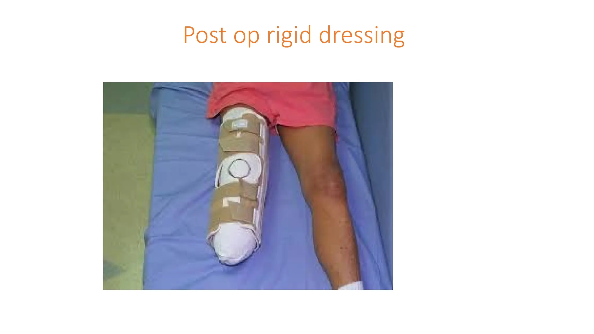 LOWER LIMB AMPUTATION Amputation is the surgical removal of a limb or ...