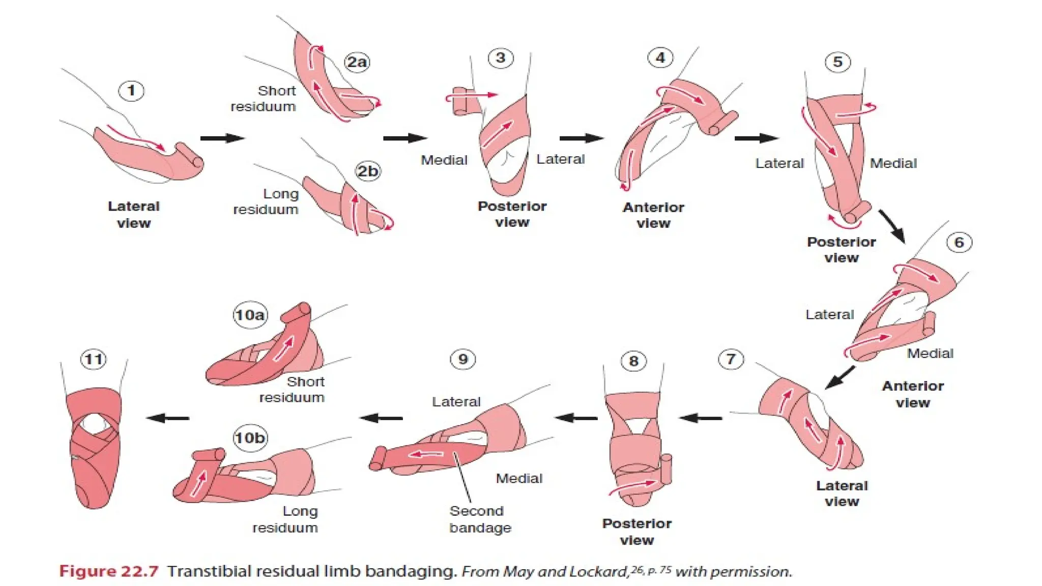 LOWER LIMB AMPUTATION Amputation is the surgical removal of a limb or ...