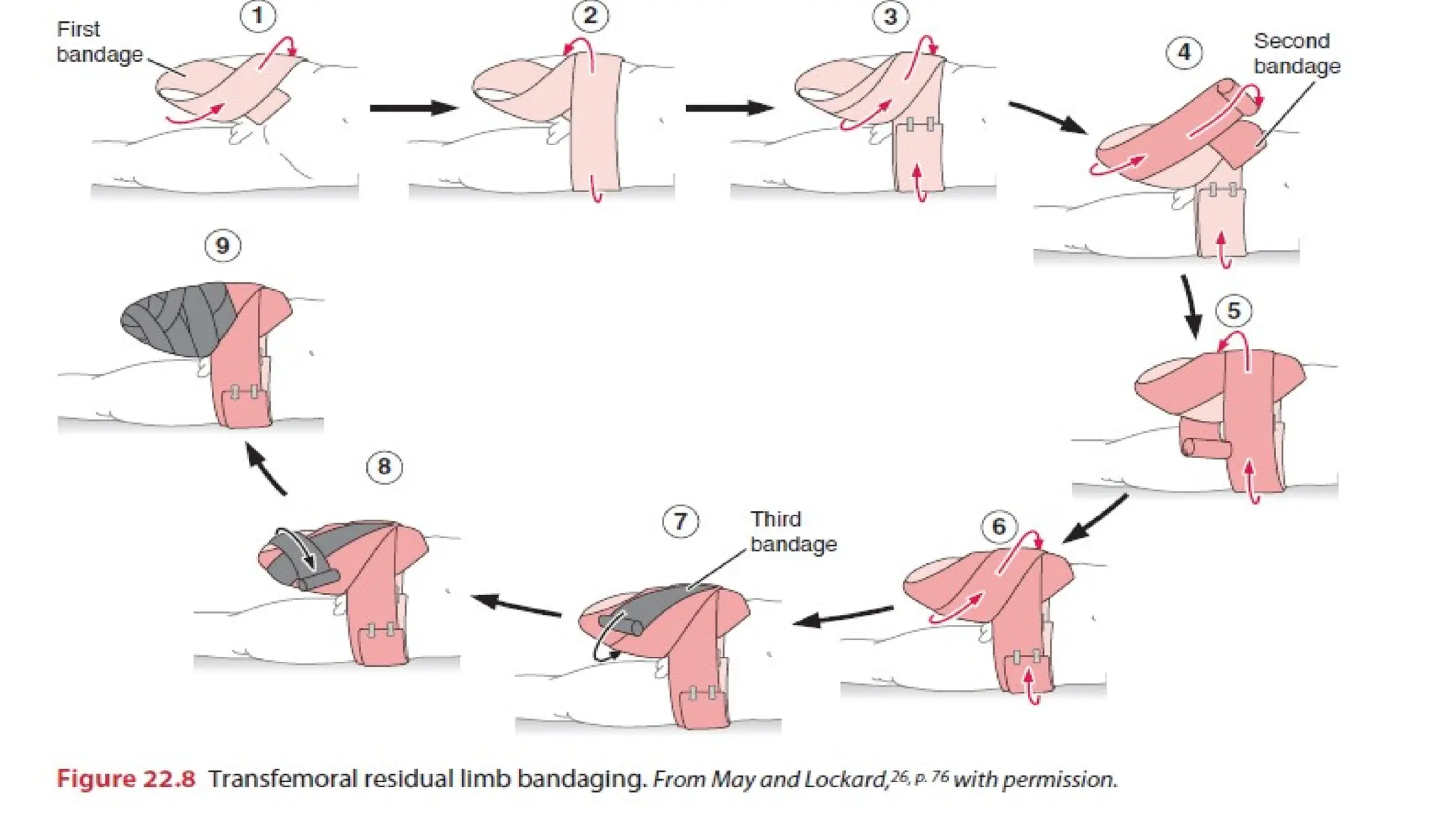 LOWER LIMB AMPUTATION Amputation is the surgical removal of a limb or ...