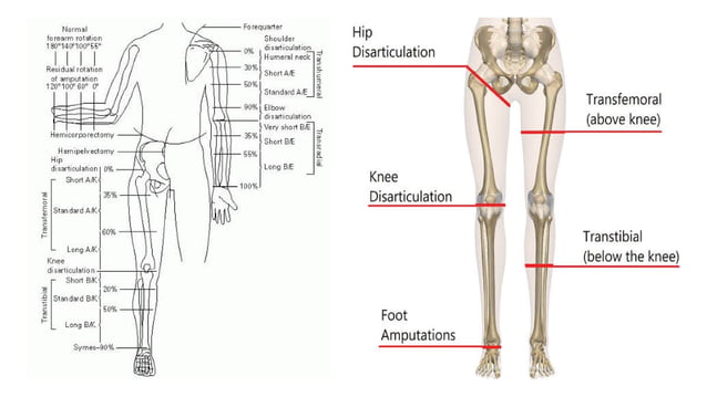LOWER LIMB AMPUTATION Amputation is the surgical removal of a limb or ...