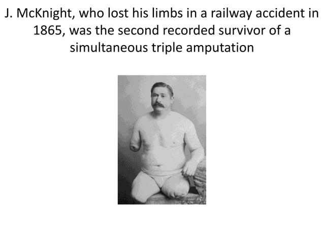 Lower Limb Amputations (Part I) | PPTX