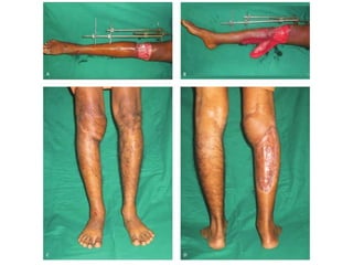 Lower Limb Defect-Thigh,Knee and Proximal Leg.pptx