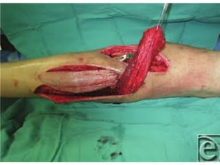 Lower Limb Defect-Thigh,Knee and Proximal Leg.pptx