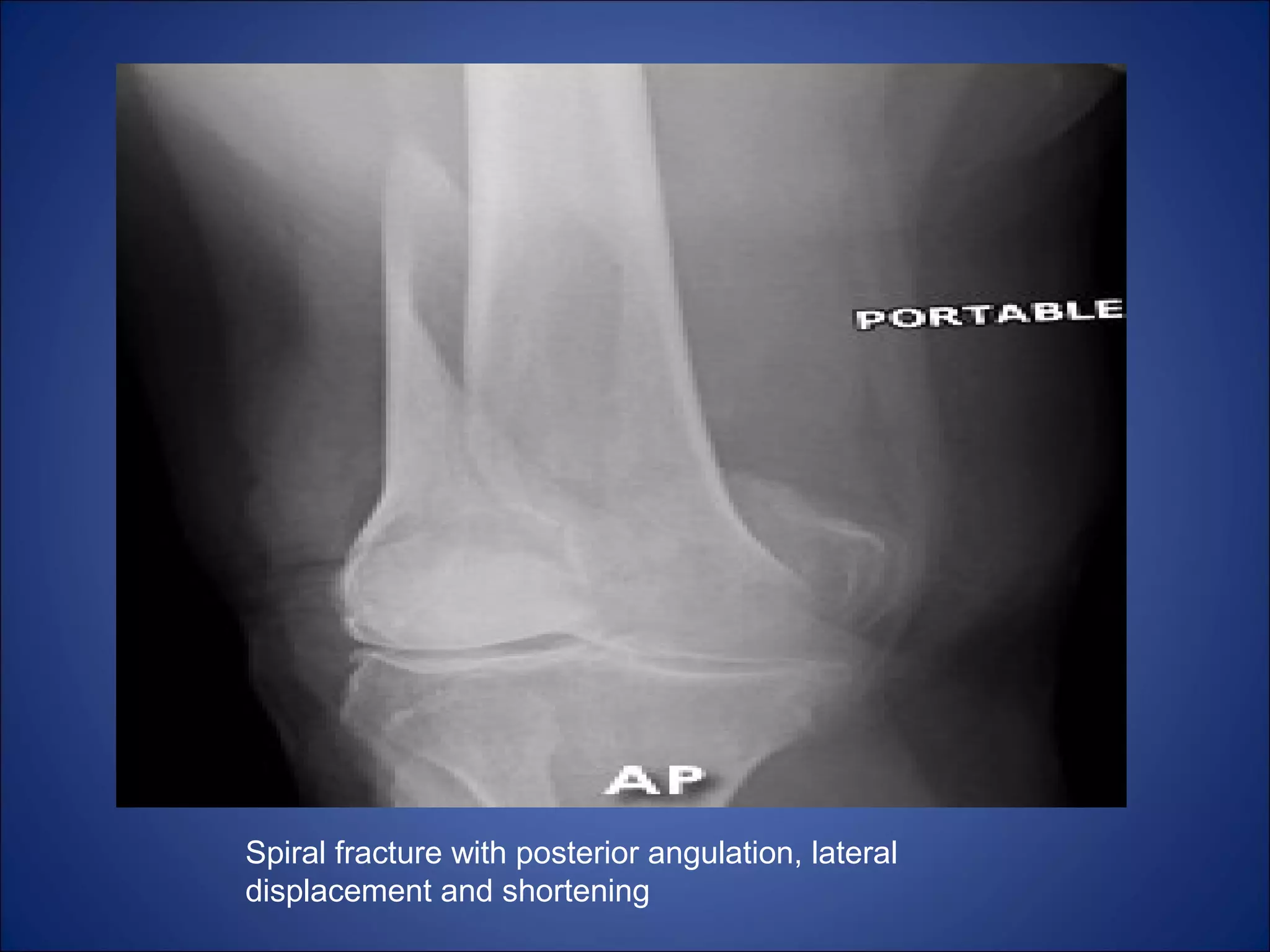 Lower limb fractures | PPT