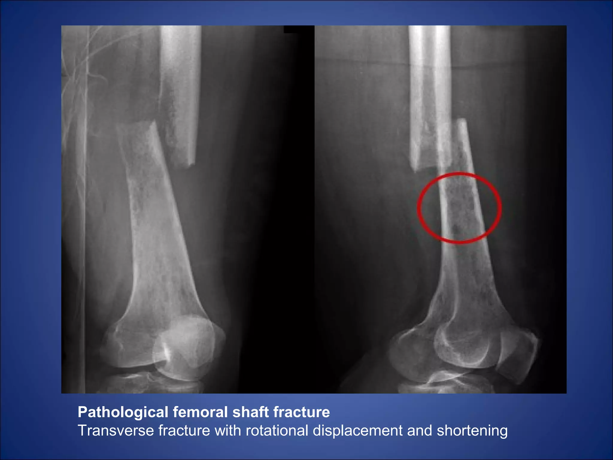 Lower limb fractures | PPT