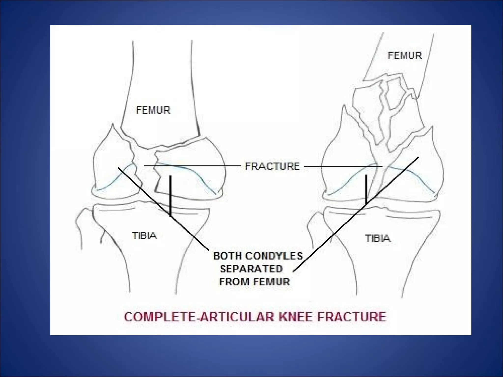 Lower limb fractures | PPT