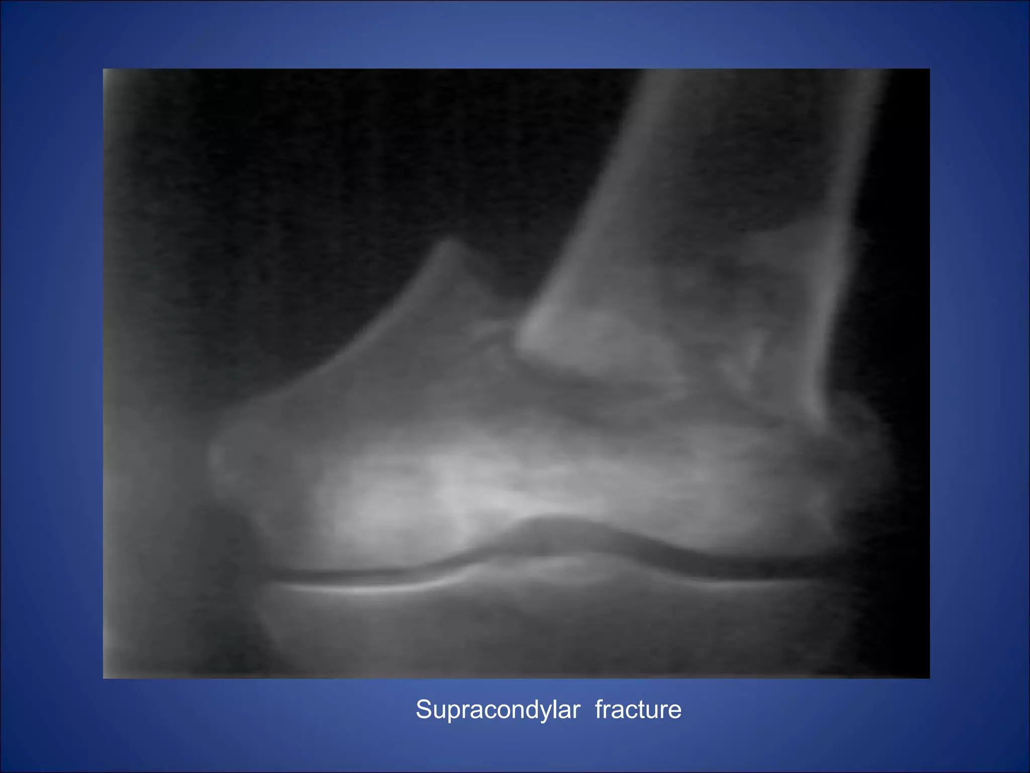 Lower limb fractures | PPT