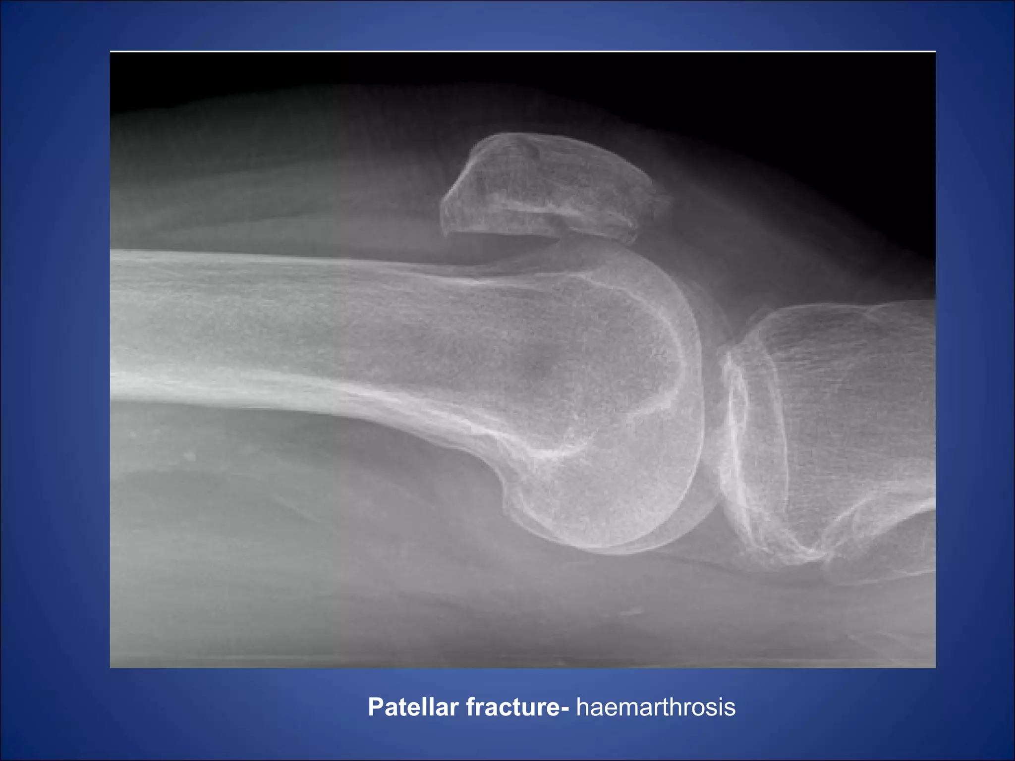 Lower limb fractures | PPT