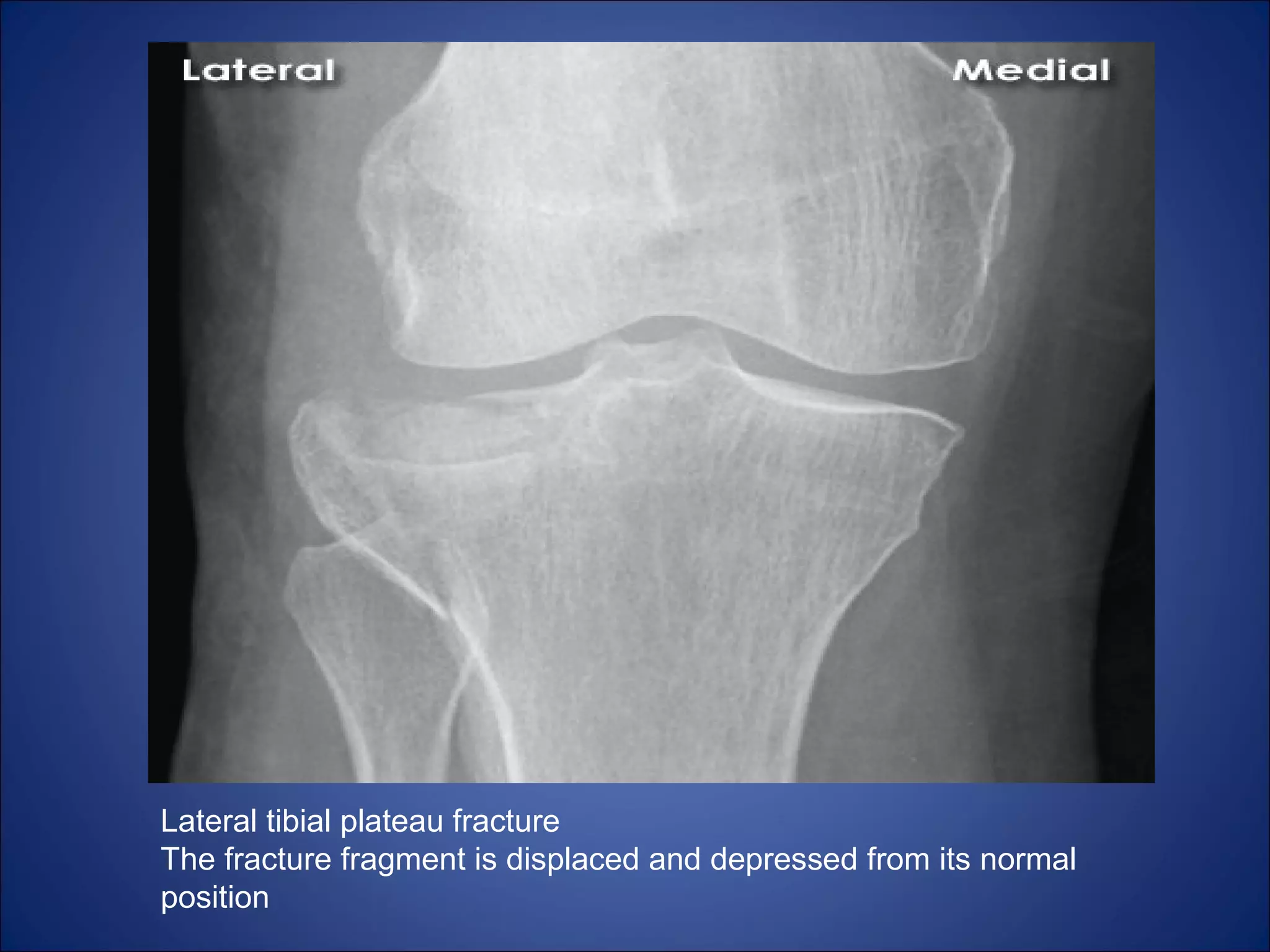 Lower limb fractures | PPT