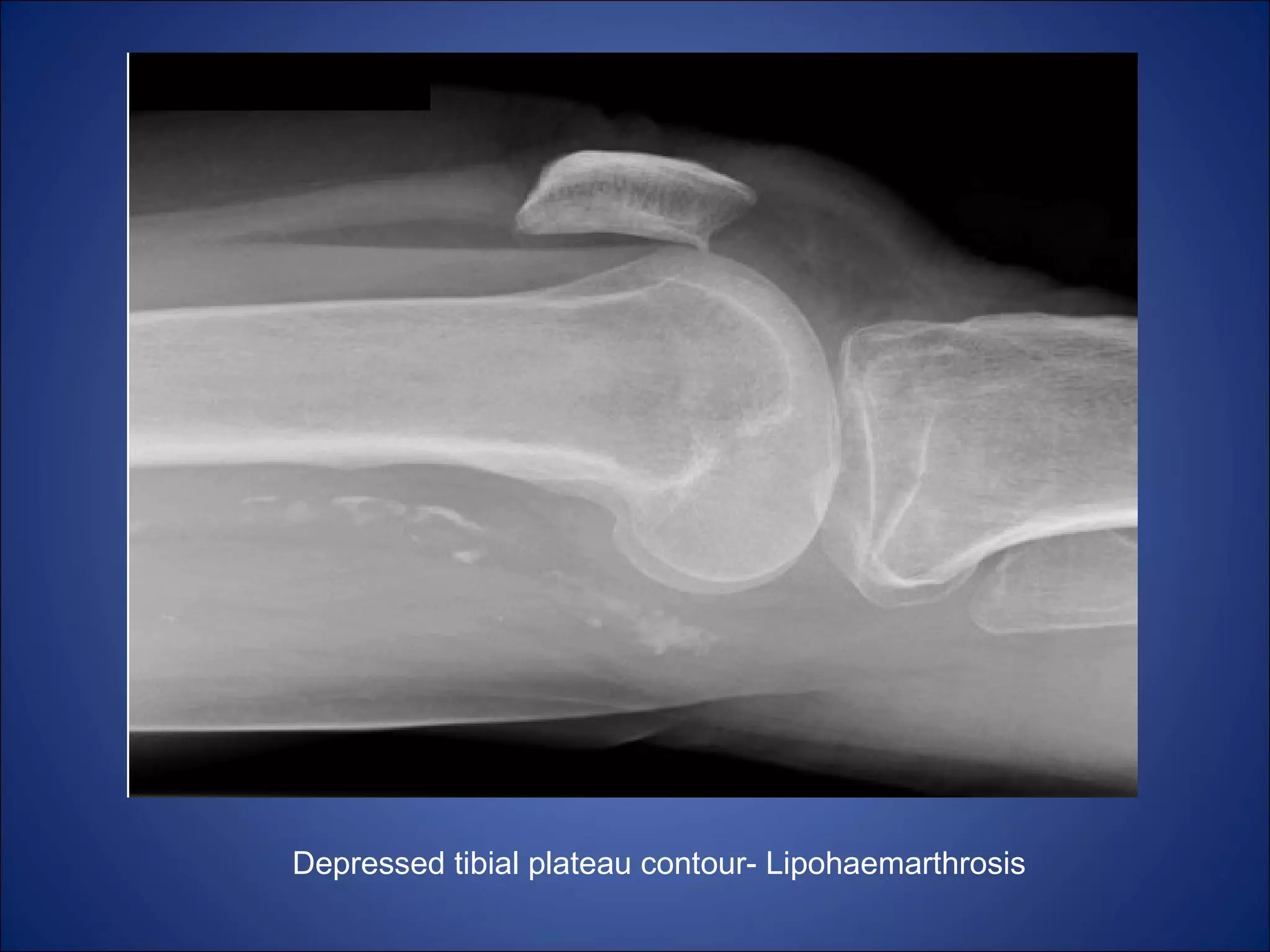 Lower limb fractures | PPT