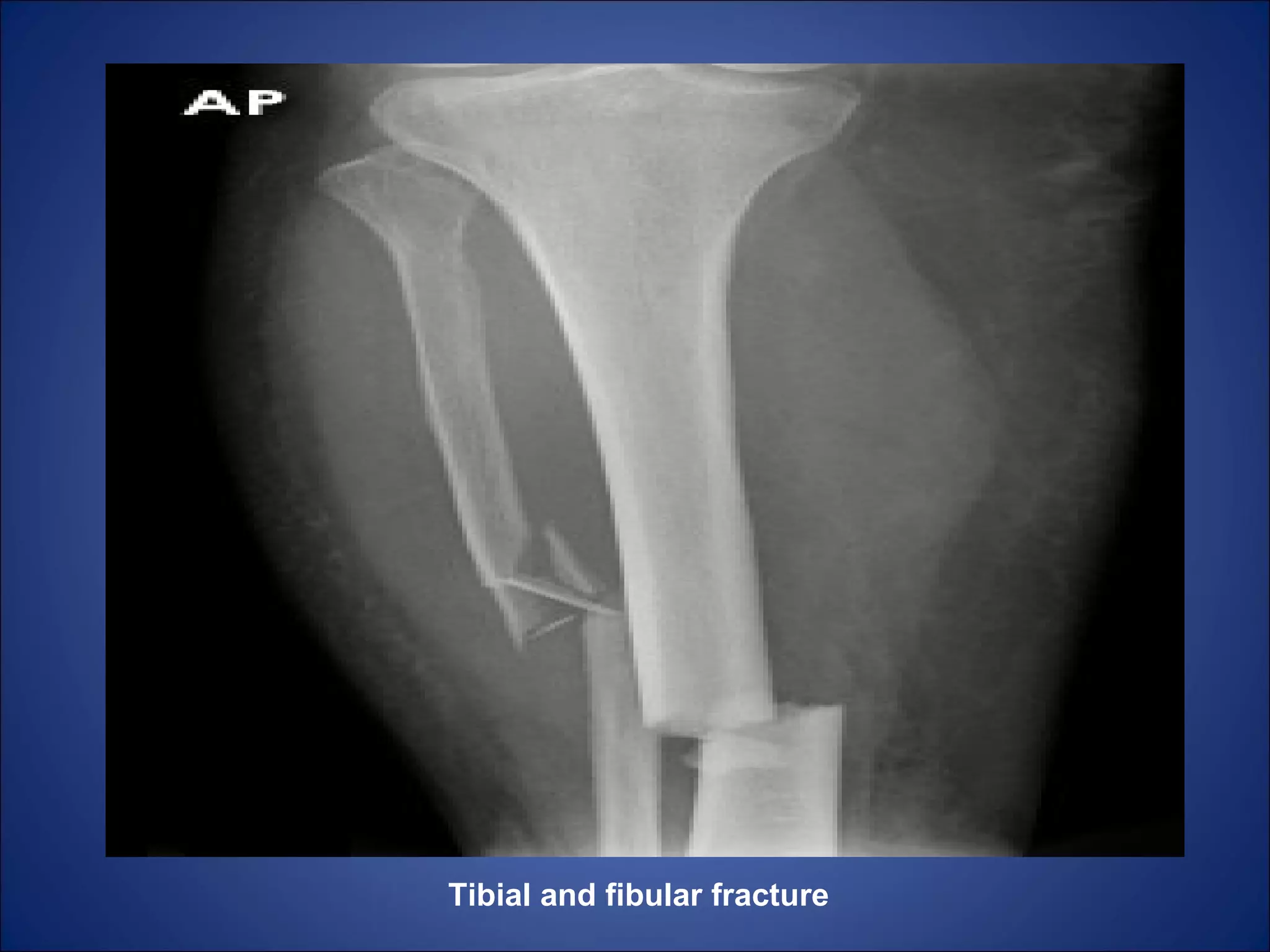 Lower limb fractures | PPT