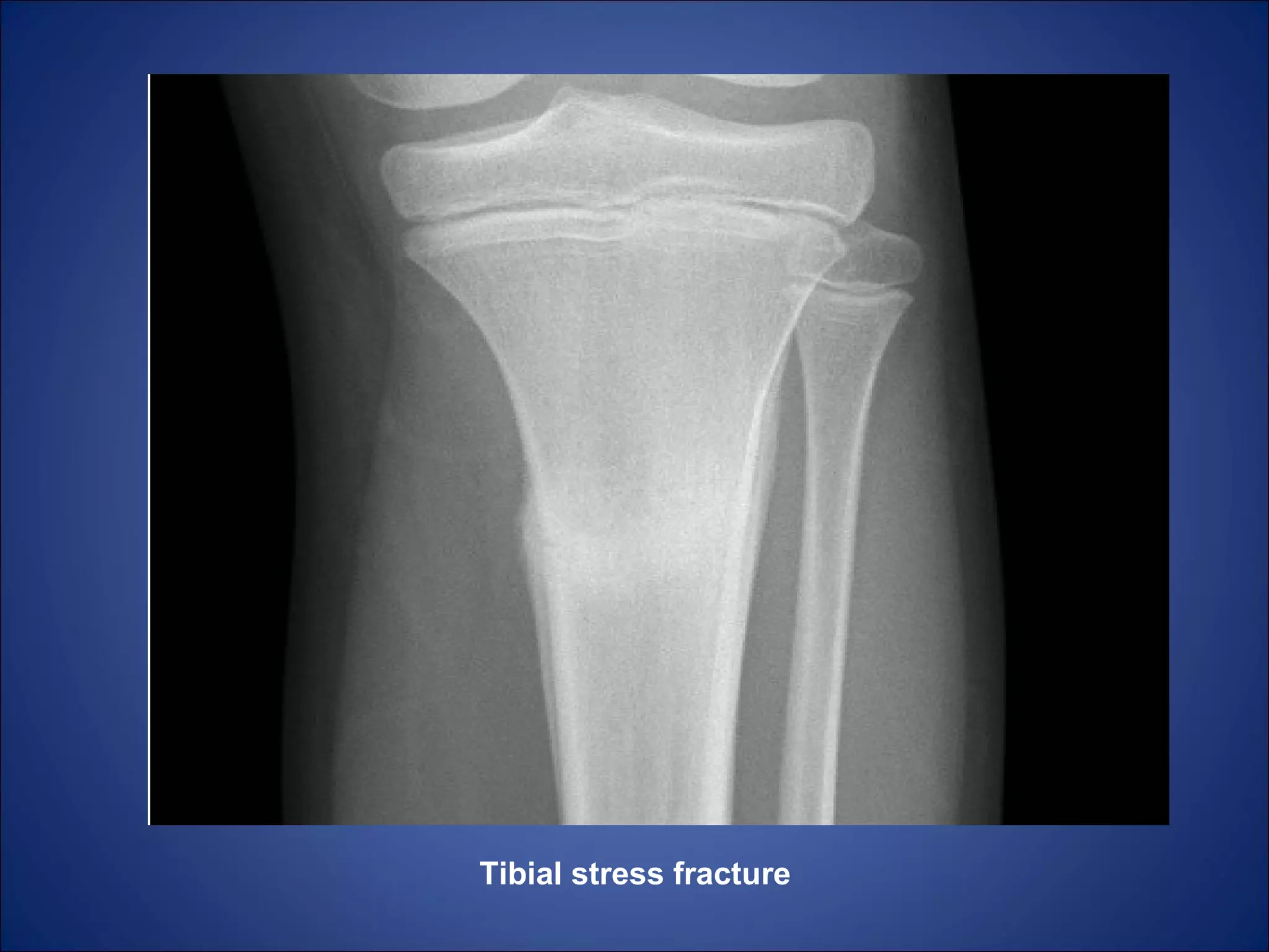 Lower limb fractures | PPT