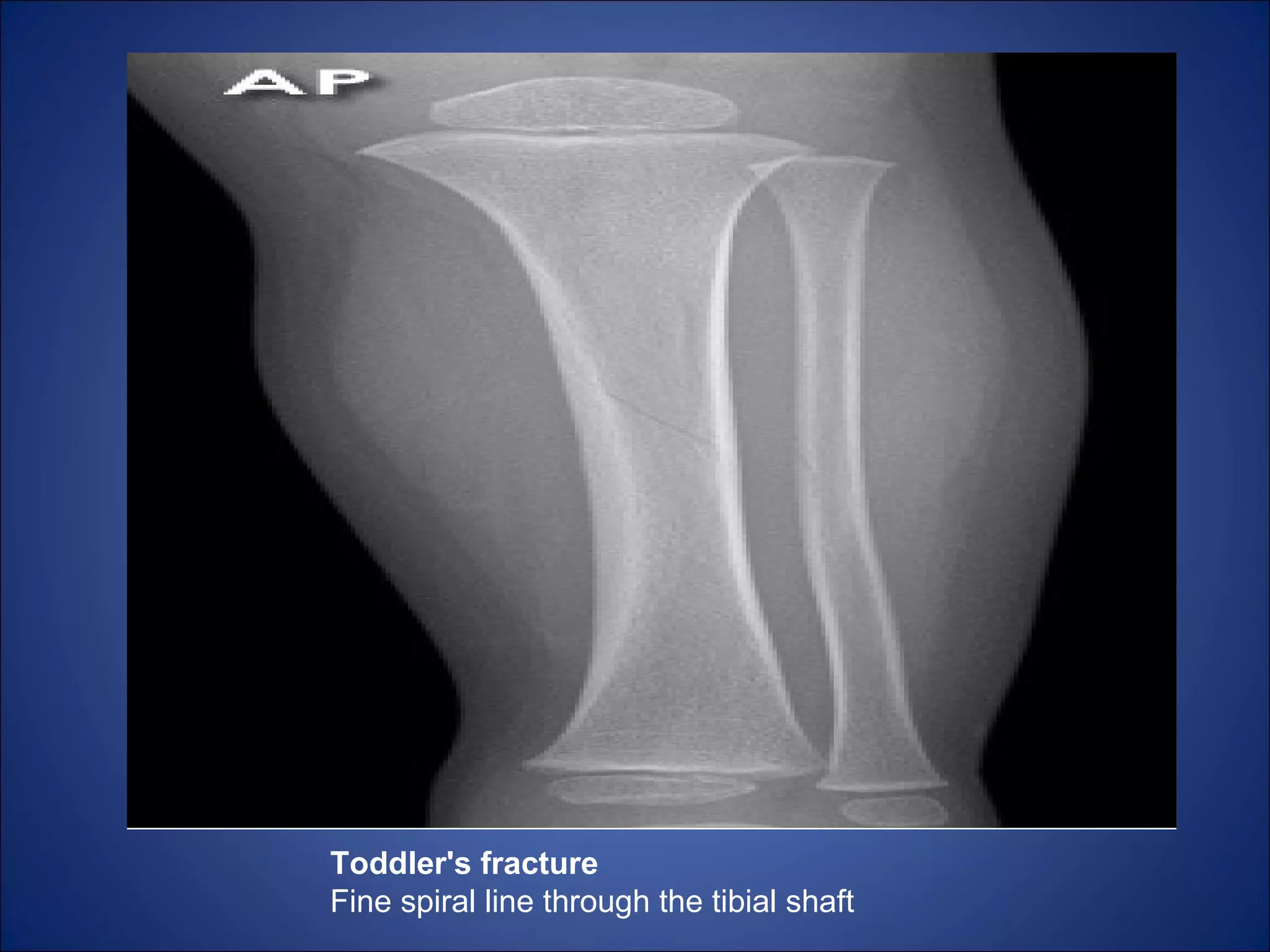 Lower limb fractures | PPT