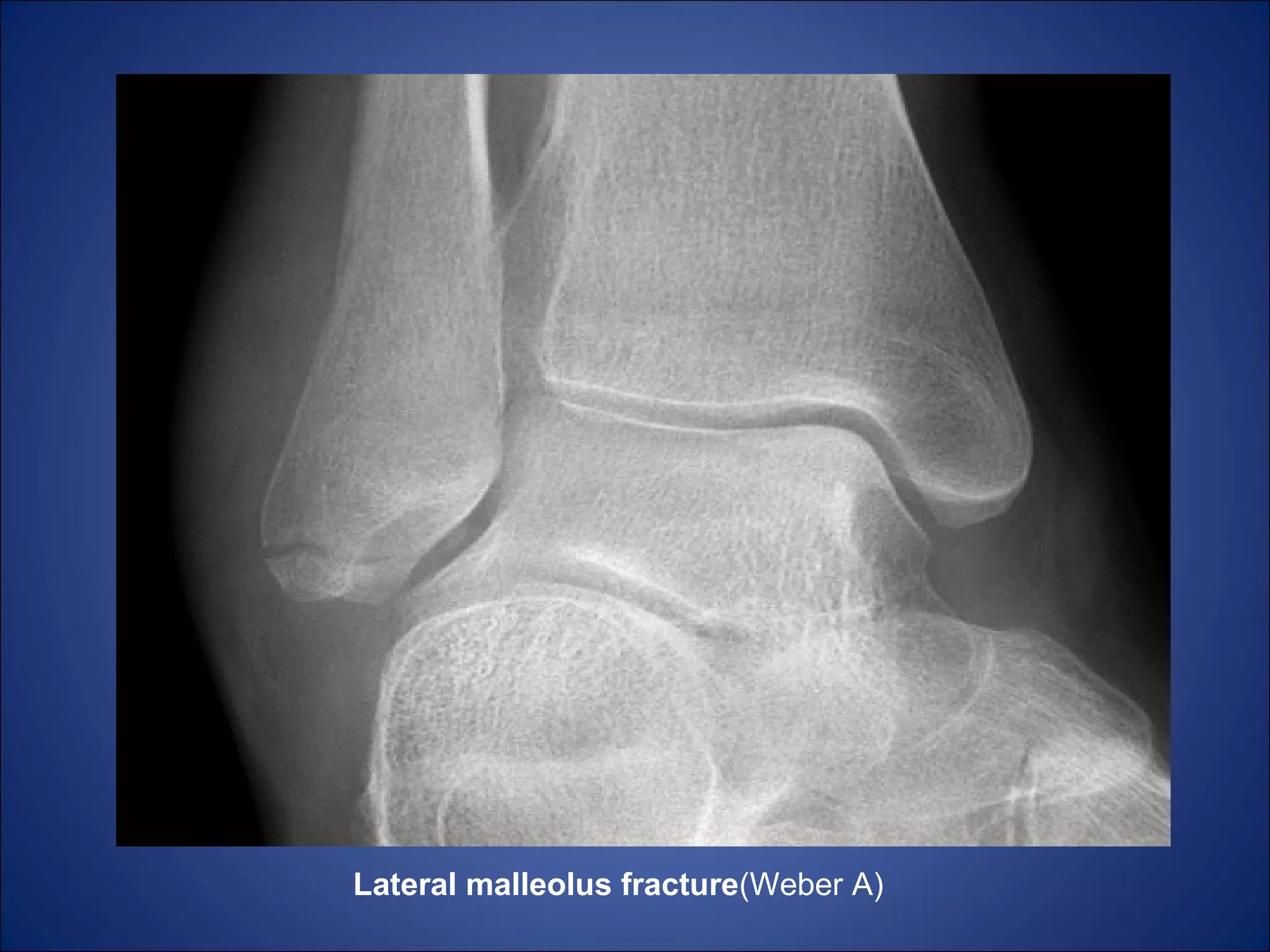 Lower limb fractures | PPT