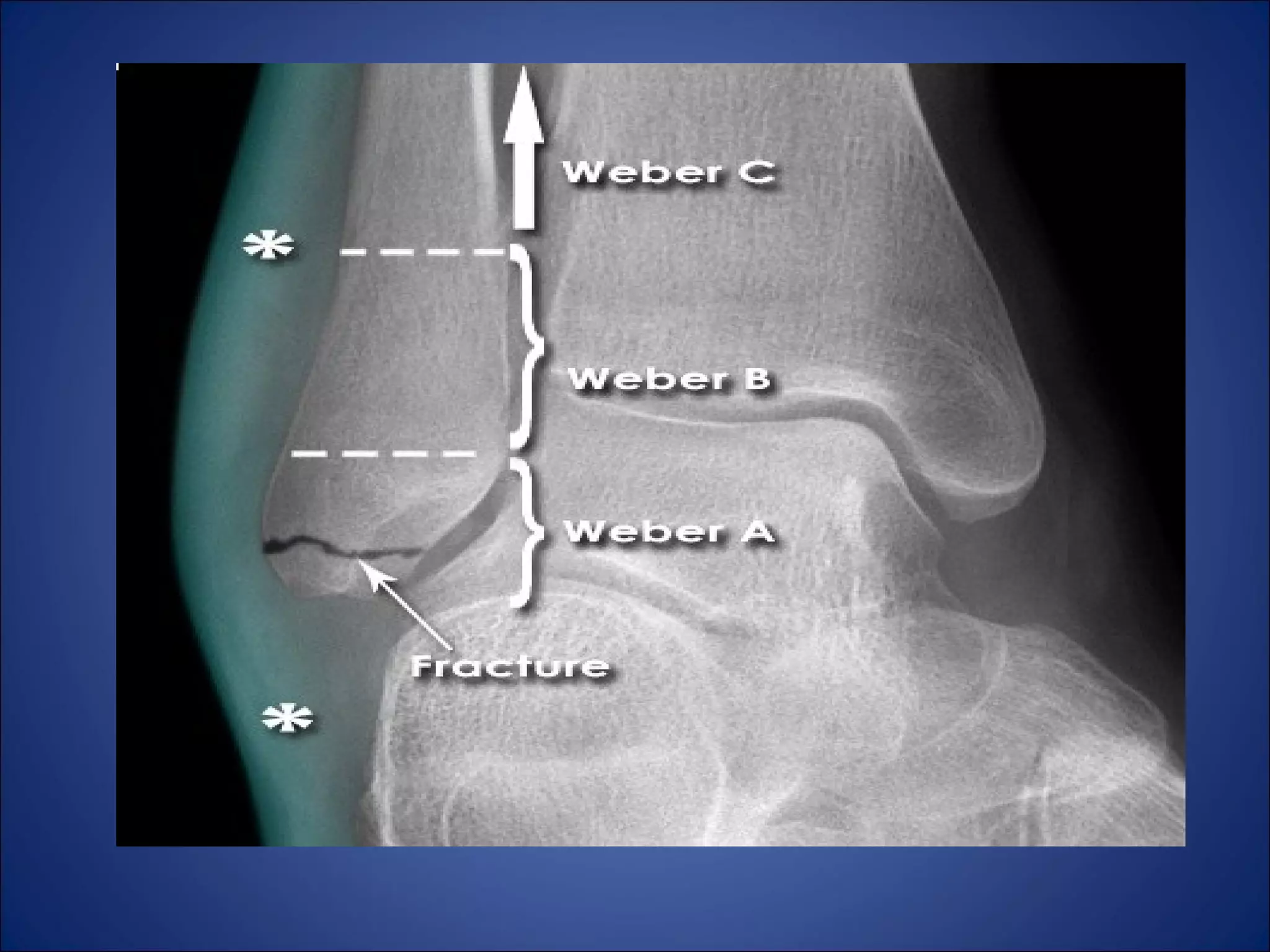 Lower limb fractures | PPT