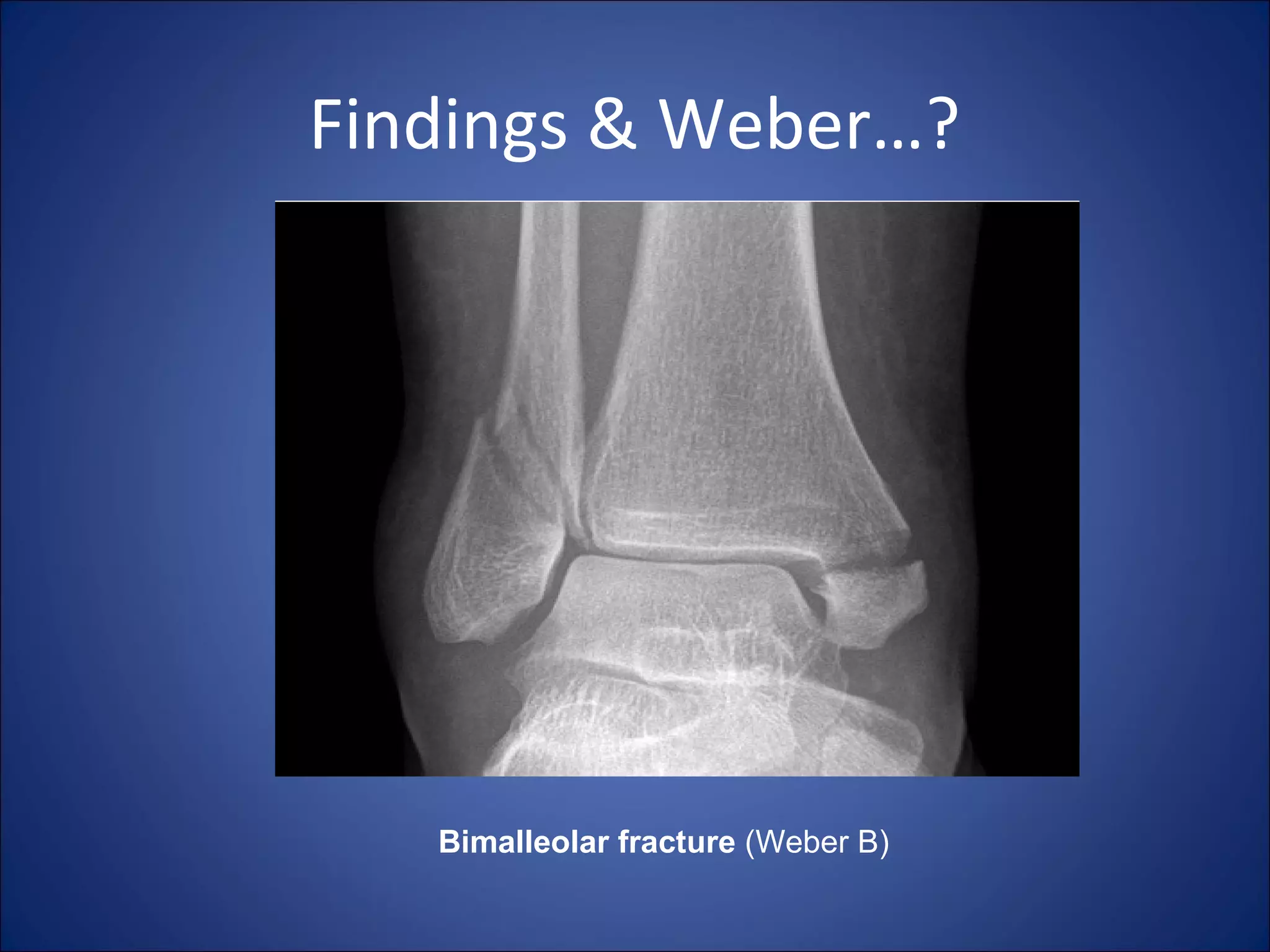 Lower limb fractures | PPT