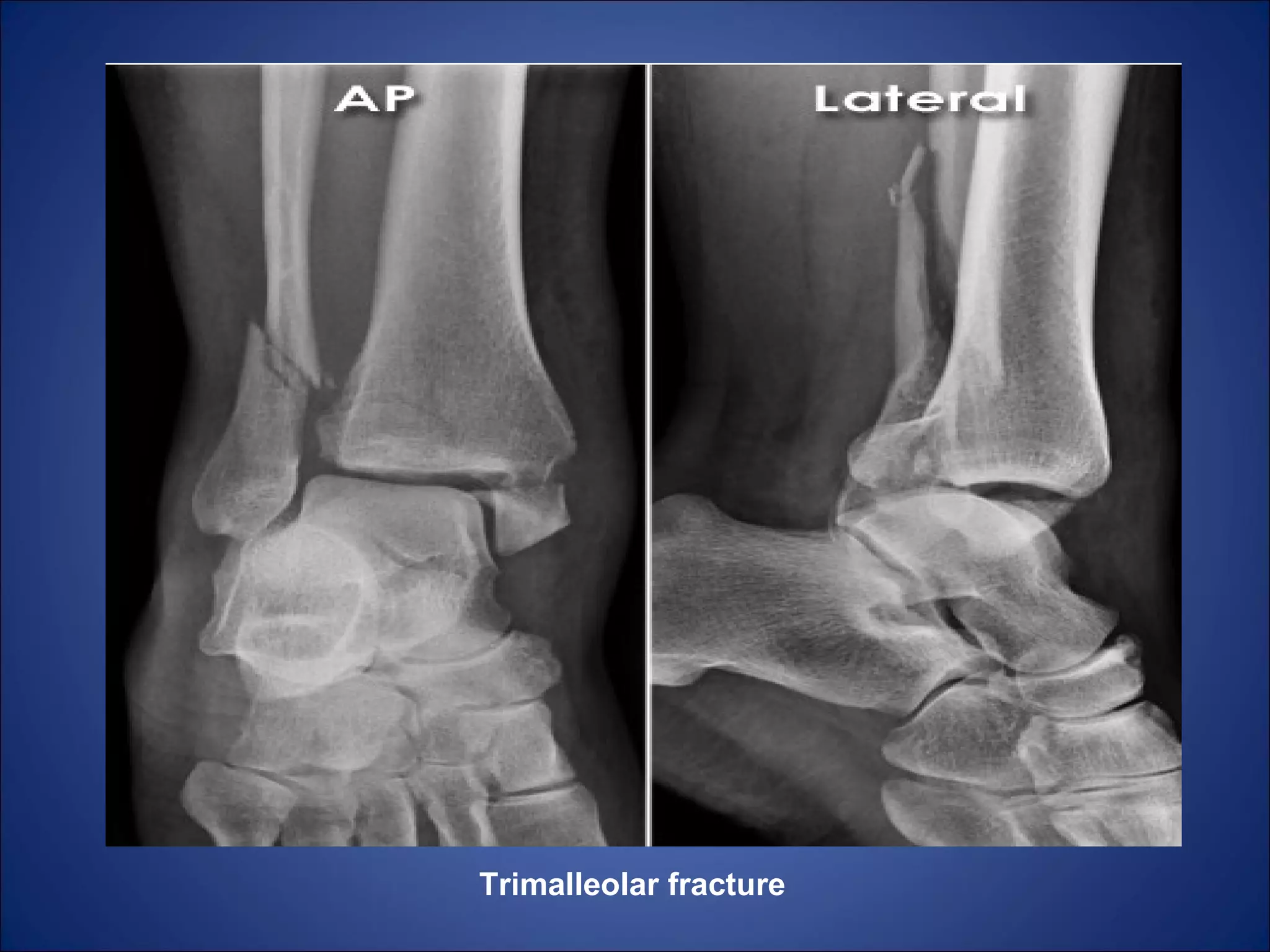 Lower limb fractures | PPT