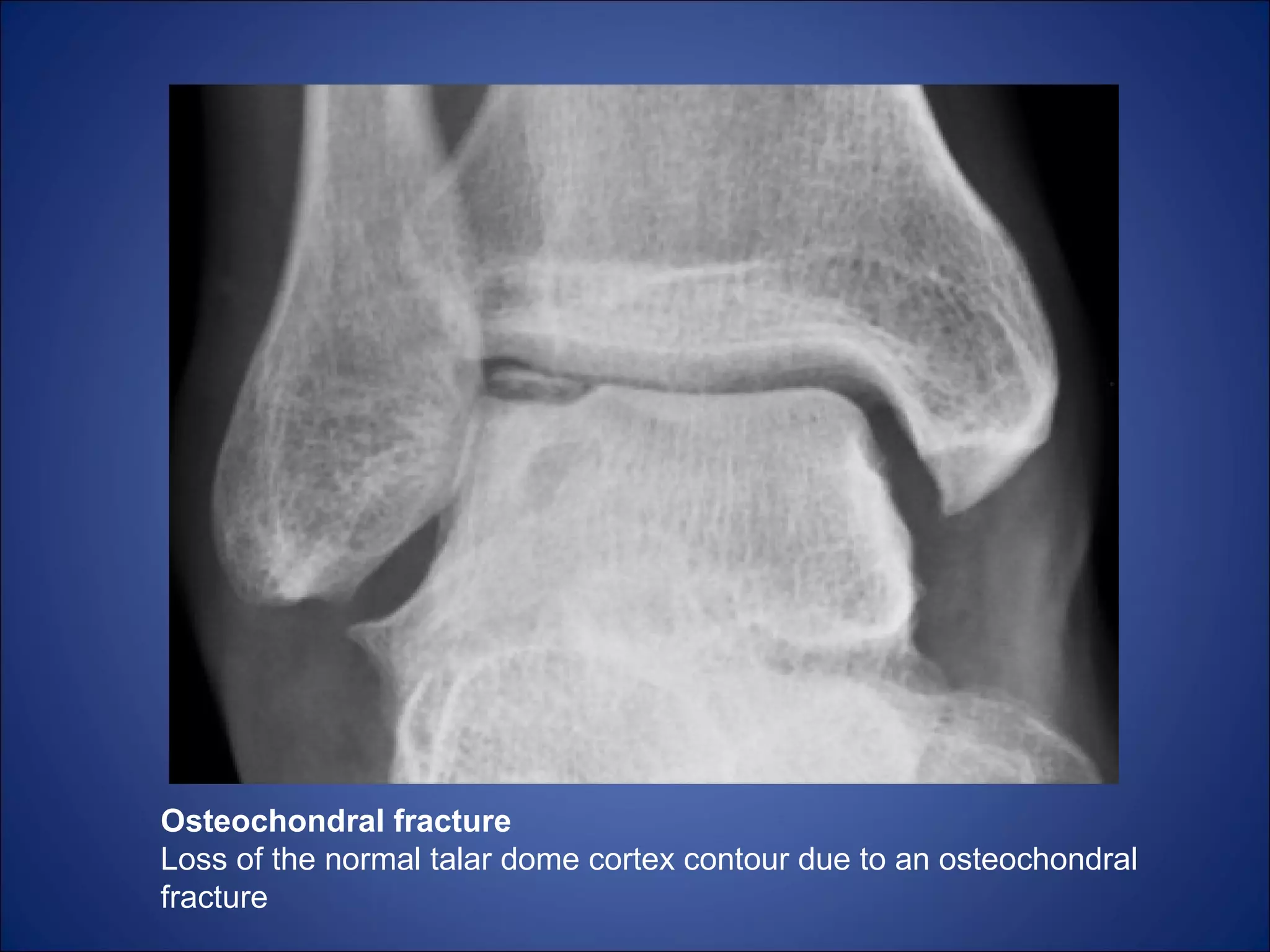 Lower limb fractures | PPT