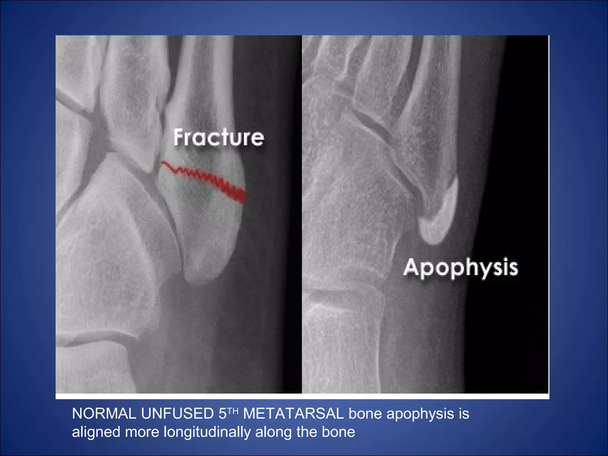 Lower limb fractures | PPT