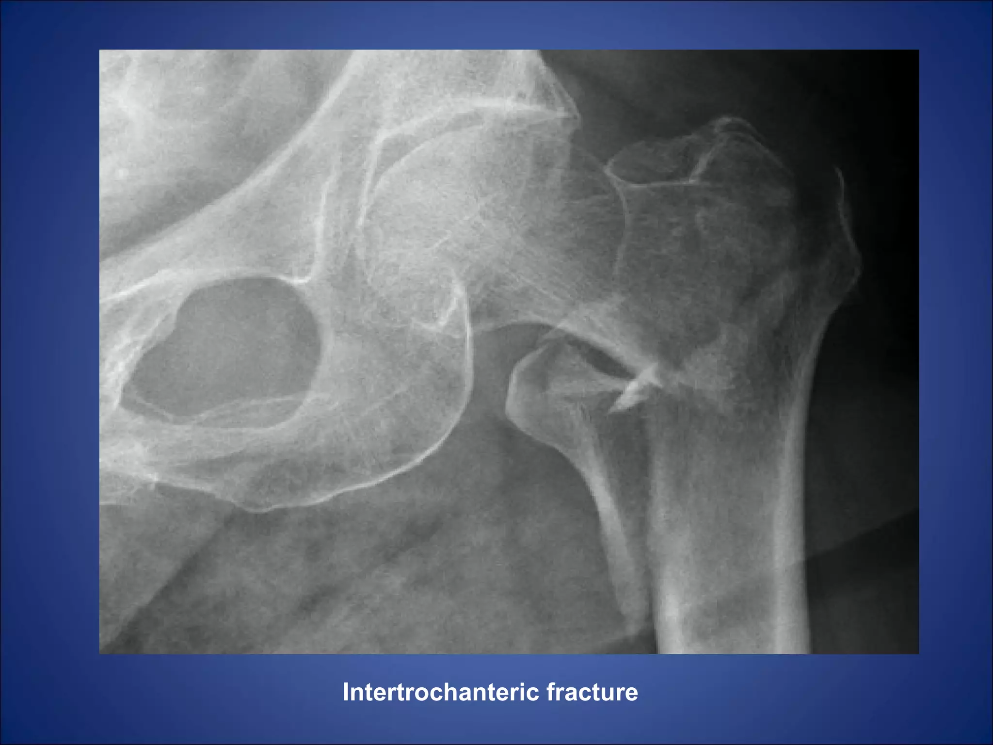 Lower limb fractures | PPT