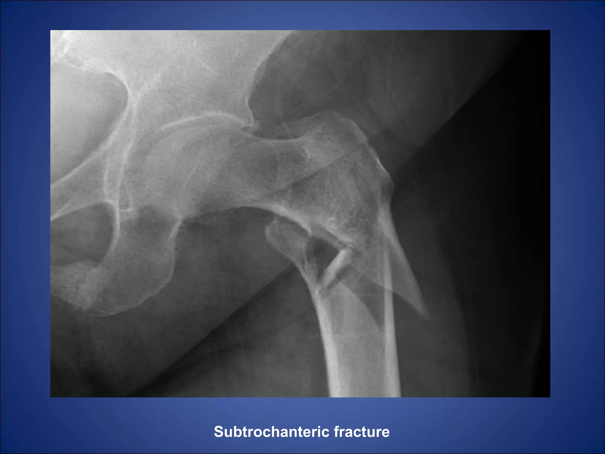 Lower limb fractures | PPT