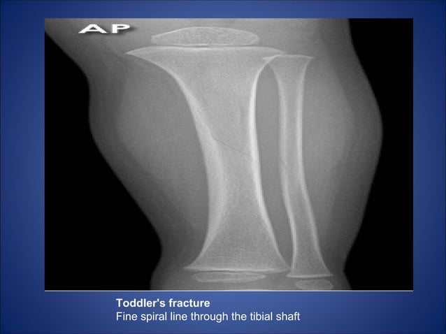 Lower limb fractures | PPT | Death, Injury, or Military Conflict ...