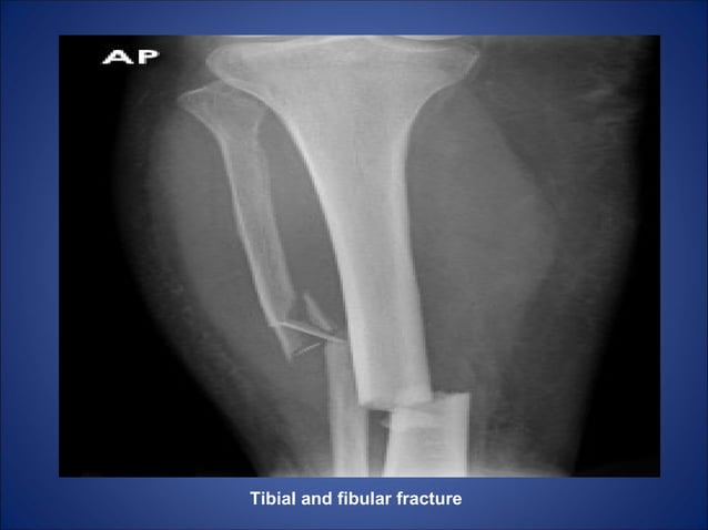 Lower limb fractures