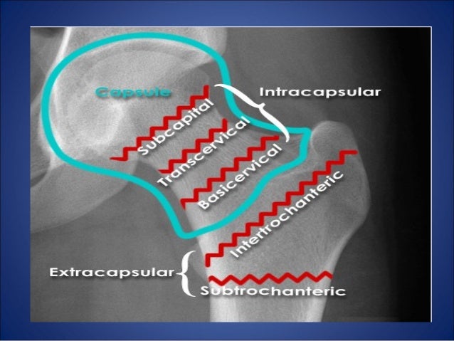 Lower limb fractures