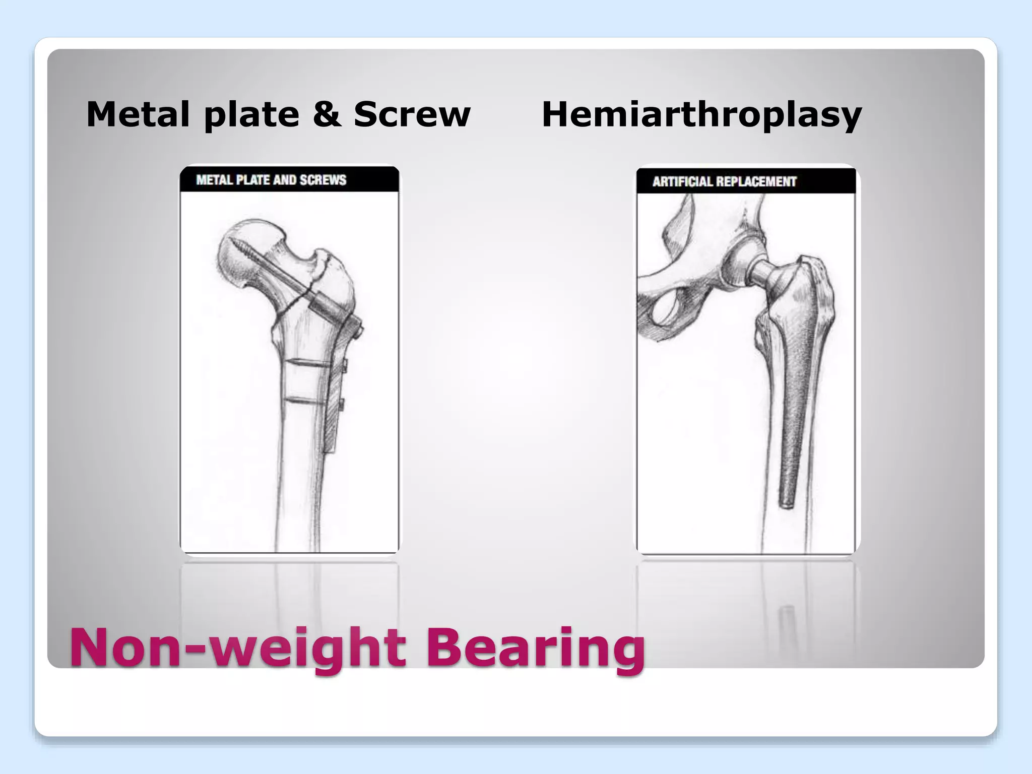 Lower limb fractures | PPTX